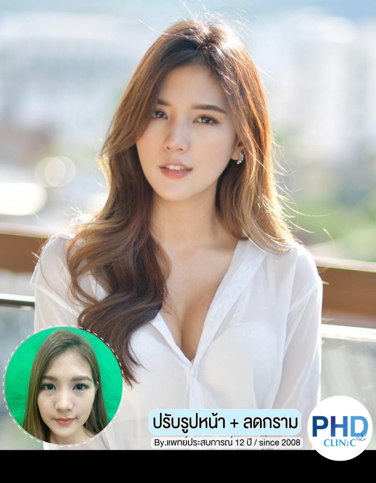 Exosome ช่วยลดเลือนรอยแผลเป็น รอยหลุมสิว