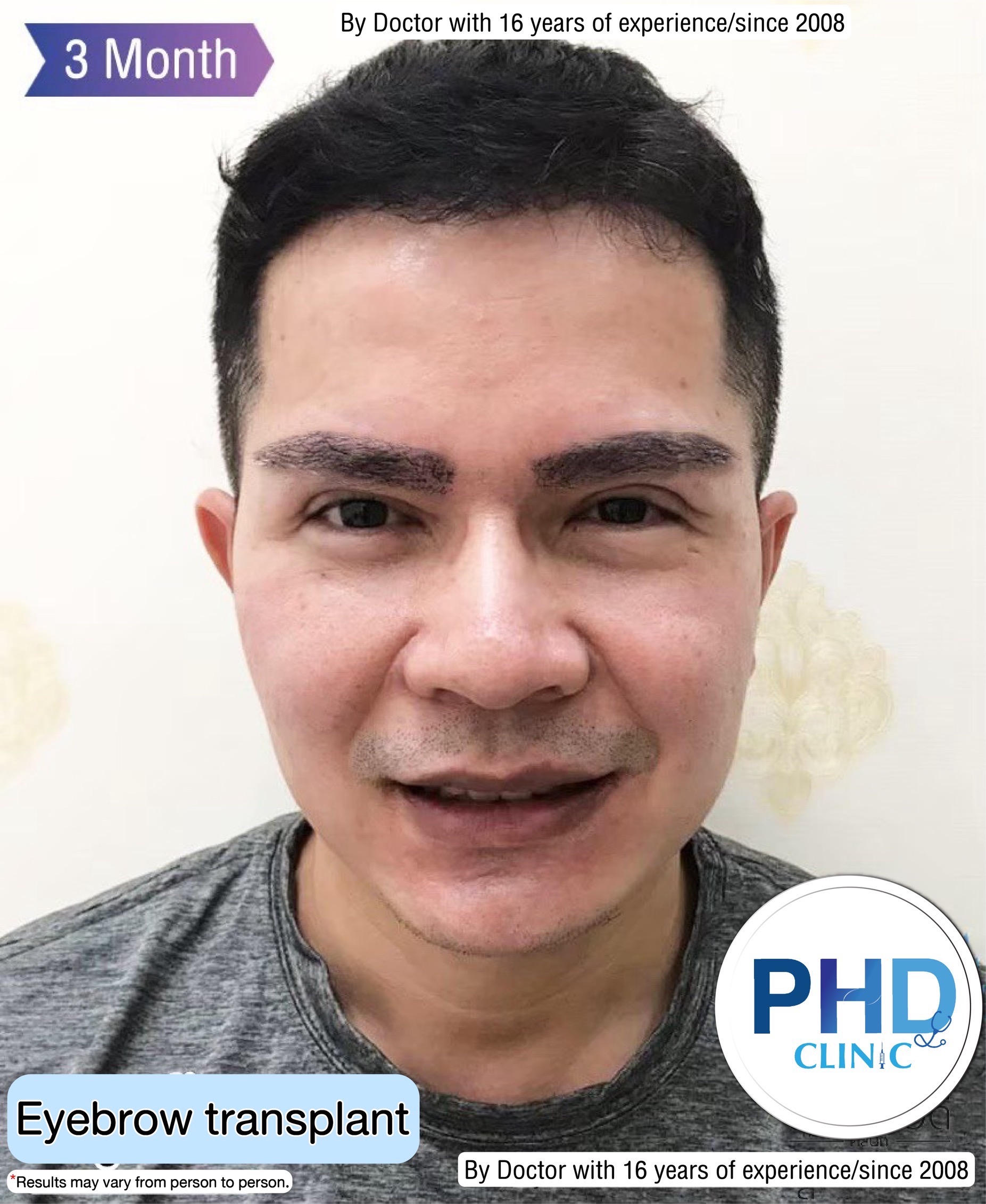 Eyebrow transplant pattaya - phd-Clinic