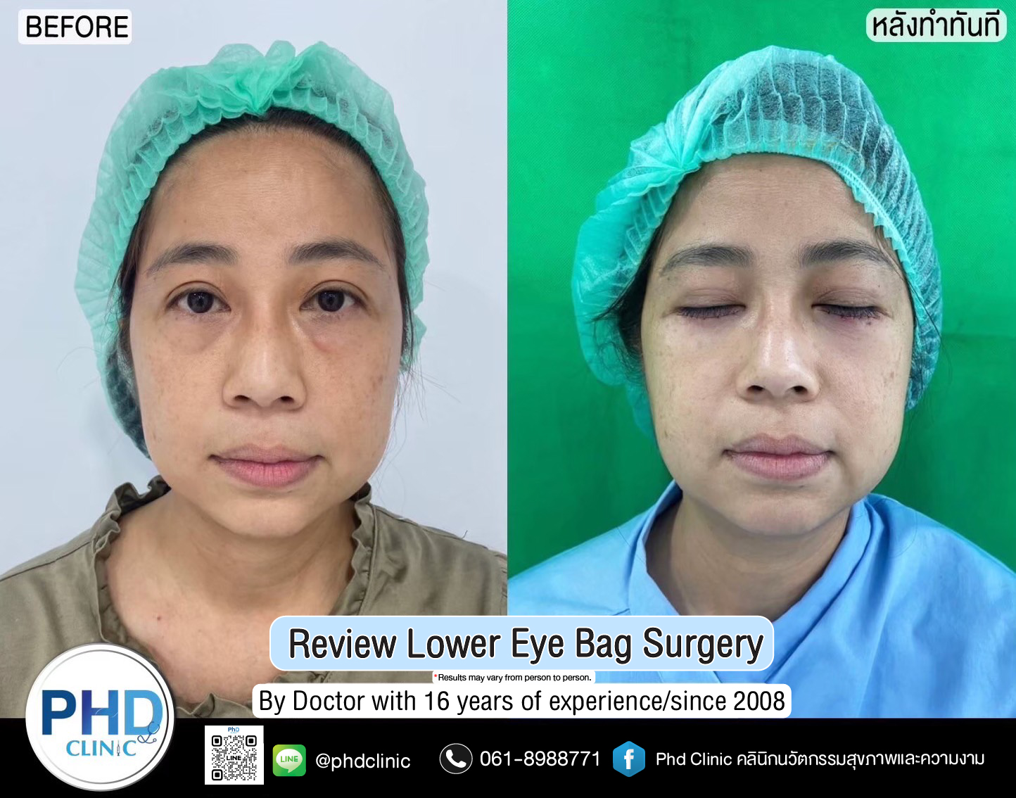 Lower Eye Bag Surgery Pattaya - phd-Clinic