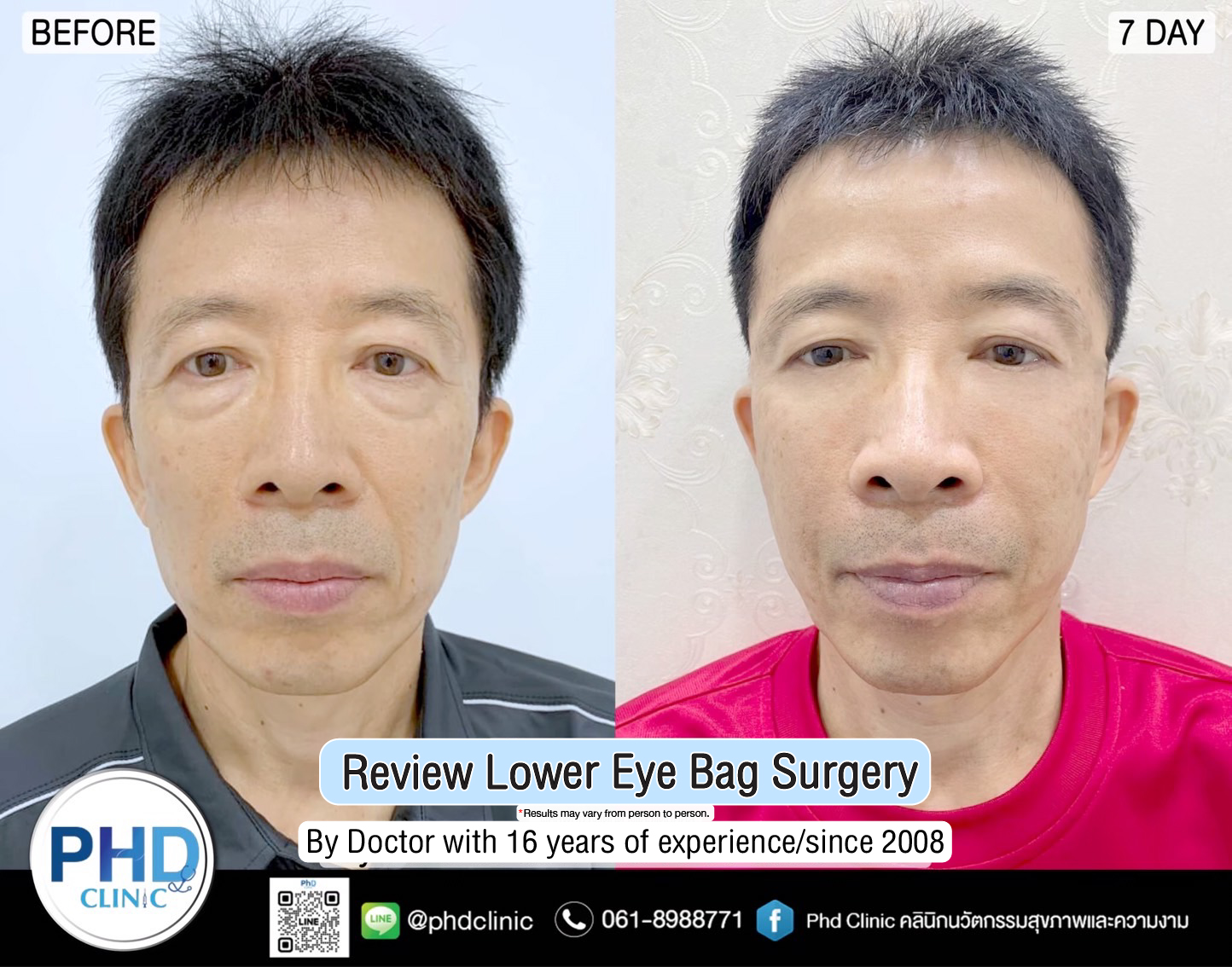 Lower Eye Bag Surgery Pattaya - phd-Clinic
