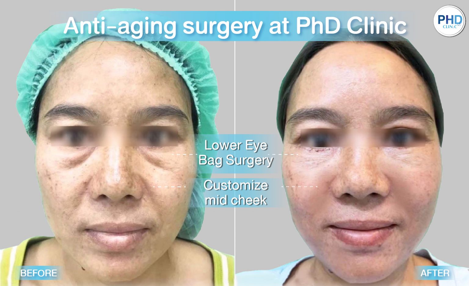 Lower Eye Bag Surgery Pattaya - phd-Clinic