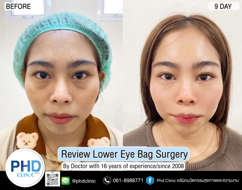 Lower Eye Bag Surgery Pattaya - phd-Clinic