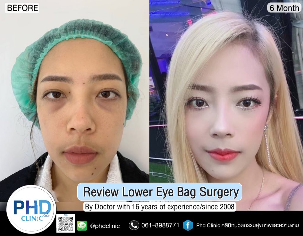 Lower Eye Bag Surgery Pattaya - phd-Clinic