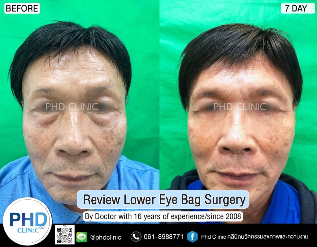 Lower Eye Bag Surgery Pattaya - phd-Clinic