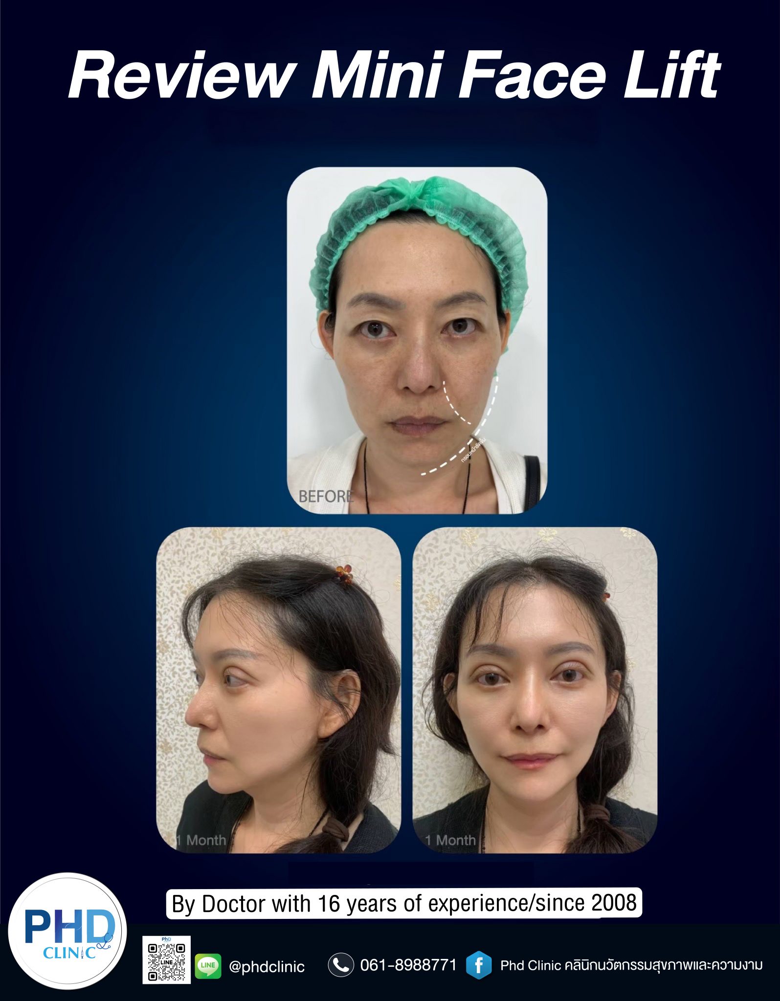 Mini Face Lift Surgery Pattaya - phd-Clinic